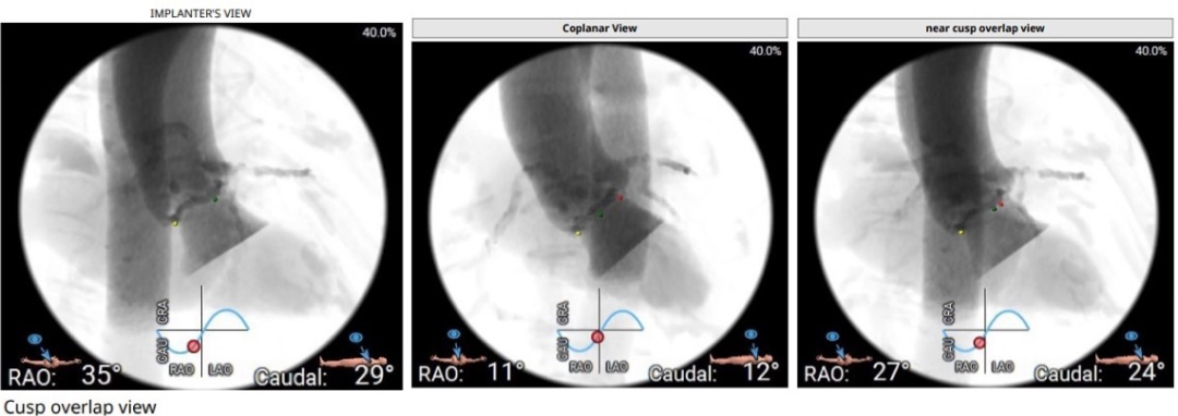 南方医院修建成团队成功应用美敦力Evolut PRO完成两例TAVR手术：极重钙化Type 0型二叶瓣+TAVR IN SAVR -- 严道医声网