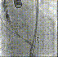 南方医院修建成团队成功应用美敦力Evolut PRO完成两例TAVR手术：极重钙化Type 0型二叶瓣+TAVR IN SAVR -- 严道医声网