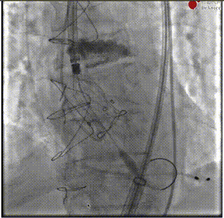 南方医院修建成团队成功应用美敦力Evolut PRO完成两例TAVR手术：极重钙化Type 0型二叶瓣+TAVR IN SAVR -- 严道医声网