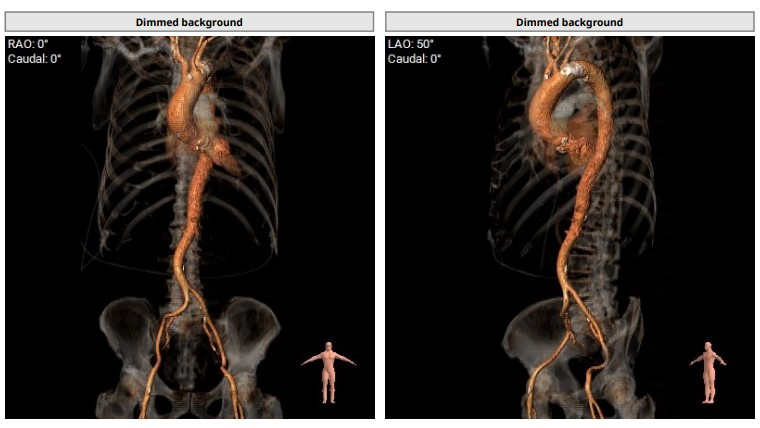南方医院修建成团队成功应用美敦力Evolut PRO完成两例TAVR手术：极重钙化Type 0型二叶瓣+TAVR IN SAVR -- 严道医声网