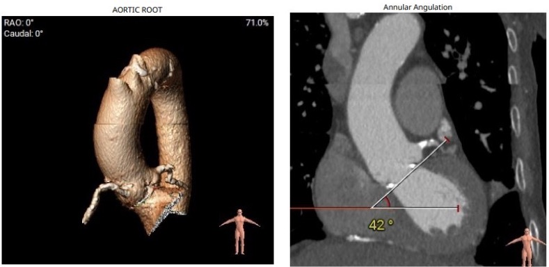 南方医院修建成团队成功应用美敦力Evolut PRO完成两例TAVR手术：极重钙化Type 0型二叶瓣+TAVR IN SAVR -- 严道医声网