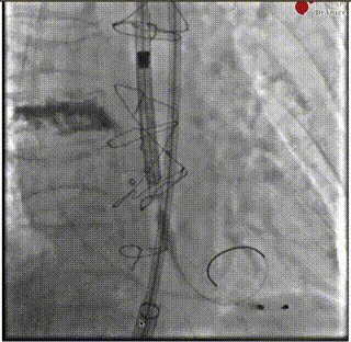 南方医院修建成团队成功应用美敦力Evolut PRO完成两例TAVR手术：极重钙化Type 0型二叶瓣+TAVR IN SAVR -- 严道医声网