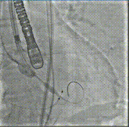 南方医院修建成团队成功应用美敦力Evolut PRO完成两例TAVR手术：极重钙化Type 0型二叶瓣+TAVR IN SAVR -- 严道医声网