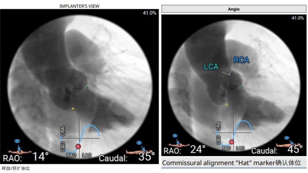 南方医院修建成团队成功应用美敦力Evolut PRO完成两例TAVR手术：极重钙化Type 0型二叶瓣+TAVR IN SAVR -- 严道医声网
