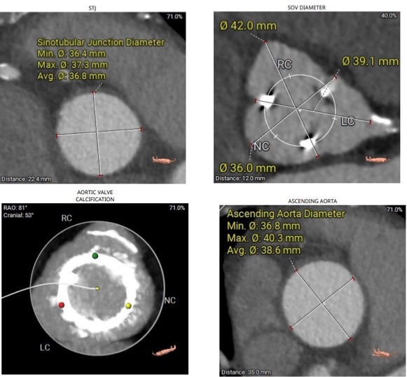 南方医院修建成团队成功应用美敦力Evolut PRO完成两例TAVR手术：极重钙化Type 0型二叶瓣+TAVR IN SAVR -- 严道医声网