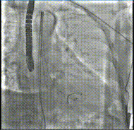 南方医院修建成团队成功应用美敦力Evolut PRO完成两例TAVR手术：极重钙化Type 0型二叶瓣+TAVR IN SAVR -- 严道医声网