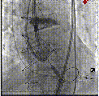 南方医院修建成团队成功应用美敦力Evolut PRO完成两例TAVR手术：极重钙化Type 0型二叶瓣+TAVR IN SAVR -- 严道医声网