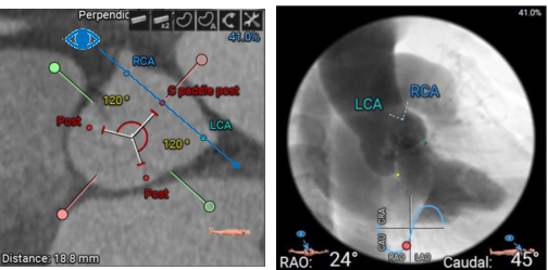 南方医院修建成团队成功应用美敦力Evolut PRO完成两例TAVR手术：极重钙化Type 0型二叶瓣+TAVR IN SAVR -- 严道医声网