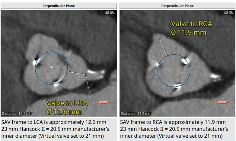 南方医院修建成团队成功应用美敦力Evolut PRO完成两例TAVR手术：极重钙化Type 0型二叶瓣+TAVR IN SAVR -- 严道医声网