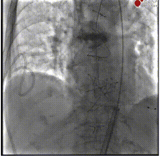 南方医院修建成团队成功应用美敦力Evolut PRO完成两例TAVR手术：极重钙化Type 0型二叶瓣+TAVR IN SAVR -- 严道医声网