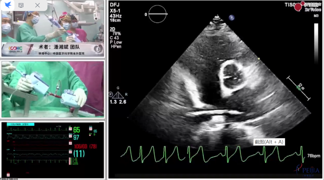 CSHC 2023｜潘湘斌教授团队成功完成局麻下单纯经胸超声引导MitraClip™植入手术演示！迎接介入治疗新时代 -- 严道医声网