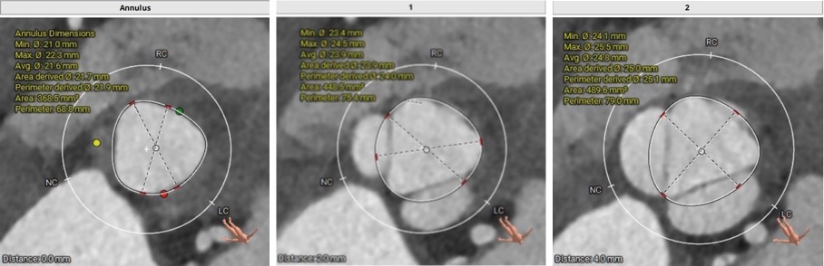 独家瓣法·胸骨畸形、重度反流｜华中科技大学同济医学院附属协和医院董念国教授团队应用J-Valve完成1例TAVR -- 严道医声网