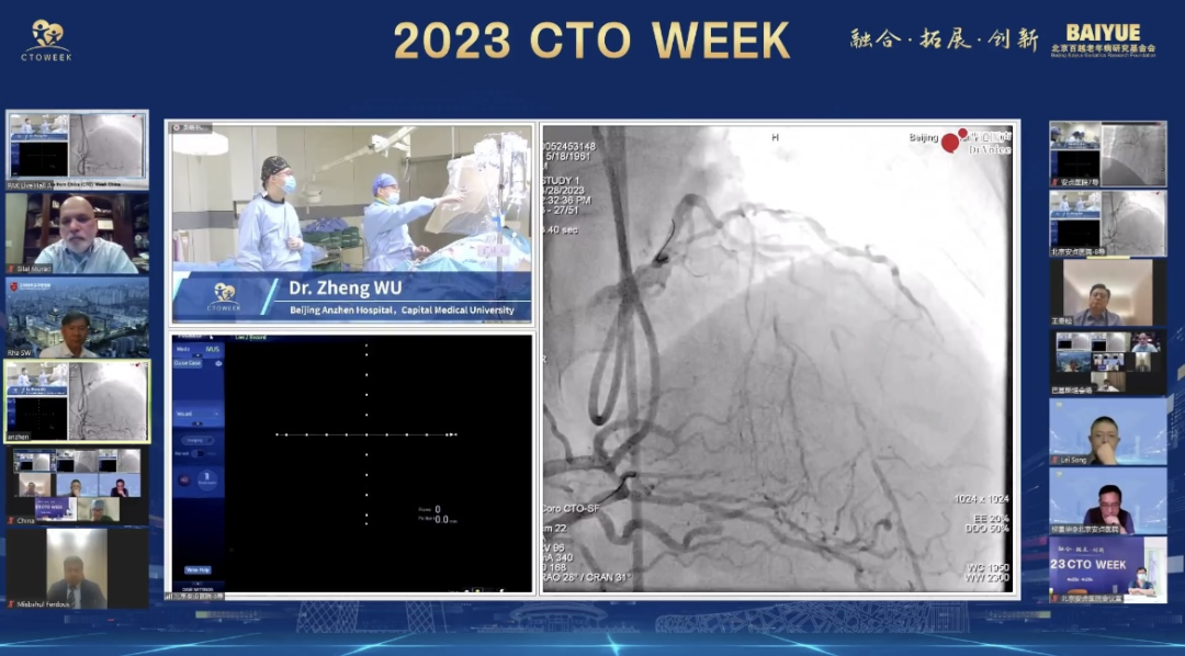 CTO WEEK 2023丨柳景华团队向巴基斯坦介入心脏病学会议现场成功转播一例高难度CTO-PCI手术 -- 严道医声网