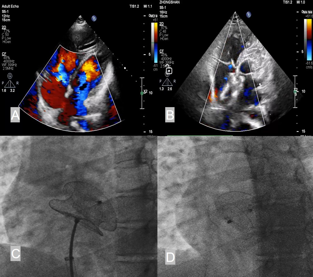 TCT 2025·中国之声｜复旦中山洪楠超医生报告两例肺动脉靶向药物联合PADN及经皮房缺封堵术序贯治疗新策略 -- 严道医声网